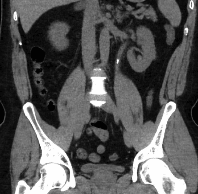 Kidney Stones: Symptoms and diagnosis