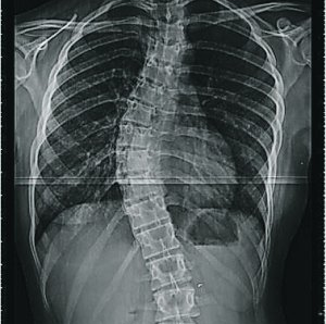 Patologías de la columna vertebral | Lumbares y Cervicales | Síntomas ...