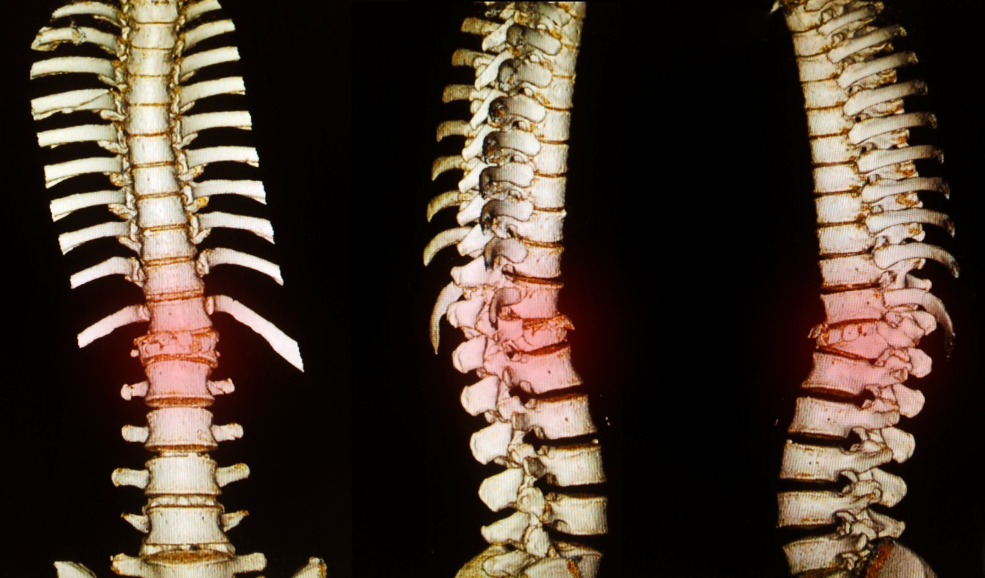 ¿Debería hacer fisioterapia después de una fractura vertebral?