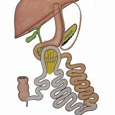 Bypass SASI -Bipartición intestinal - Dr. Rey Romero