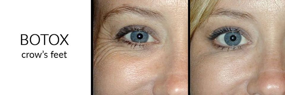 BOTOX treatment in Milton Keynes - upper face wrinkles reduction treatment