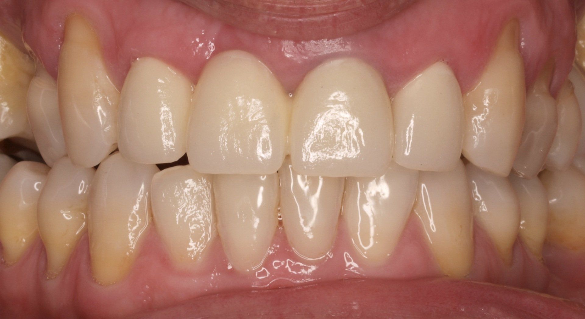 zirconio,monolitico,estratificado,disilicato,emax,cadcam