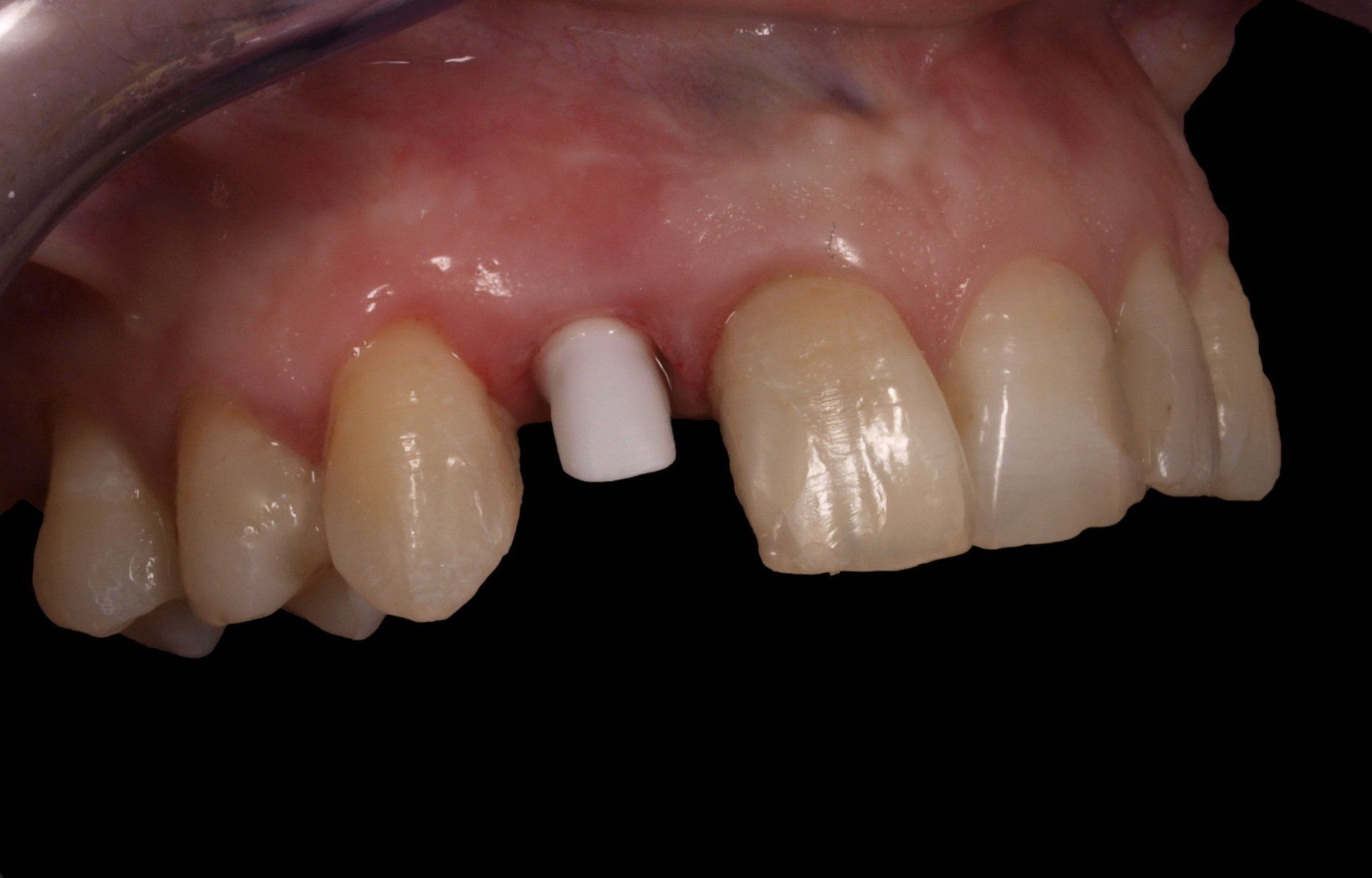 Implantes unitarios alta gama,Straumman,cirugía indolora.