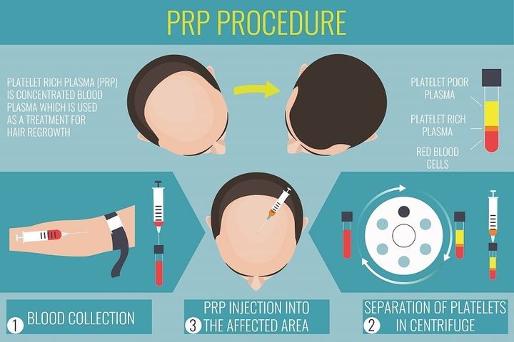 PRP and PRF Therapy in Leeds for Hair Loss and Skin.