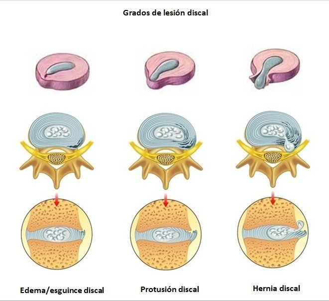 Los discos intervertebrales