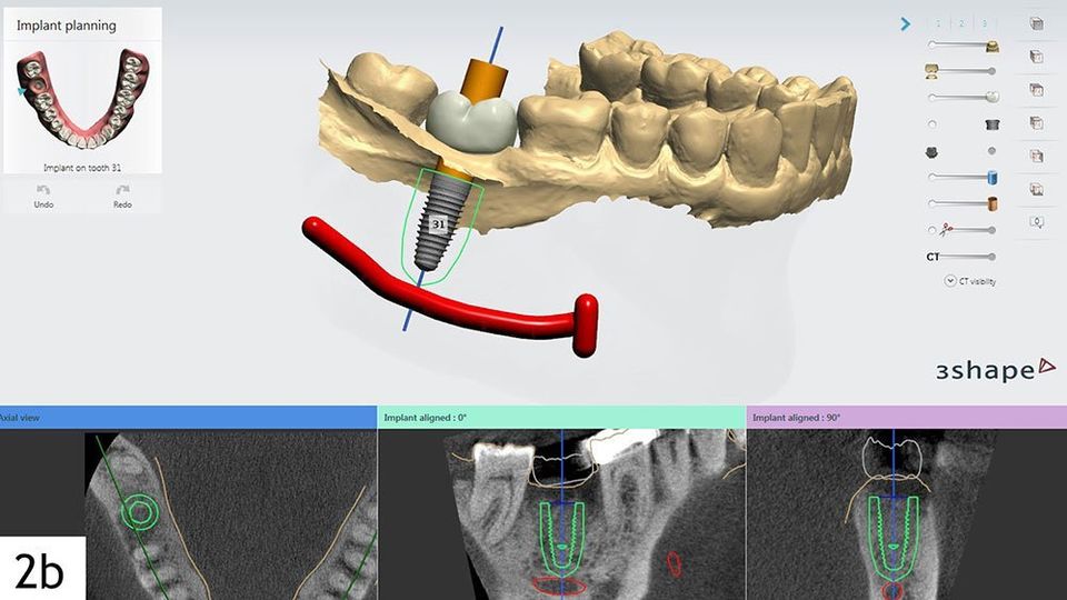 implantologie planification implantaire