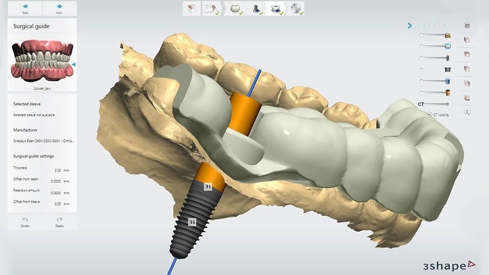 implantologie planification implantaire