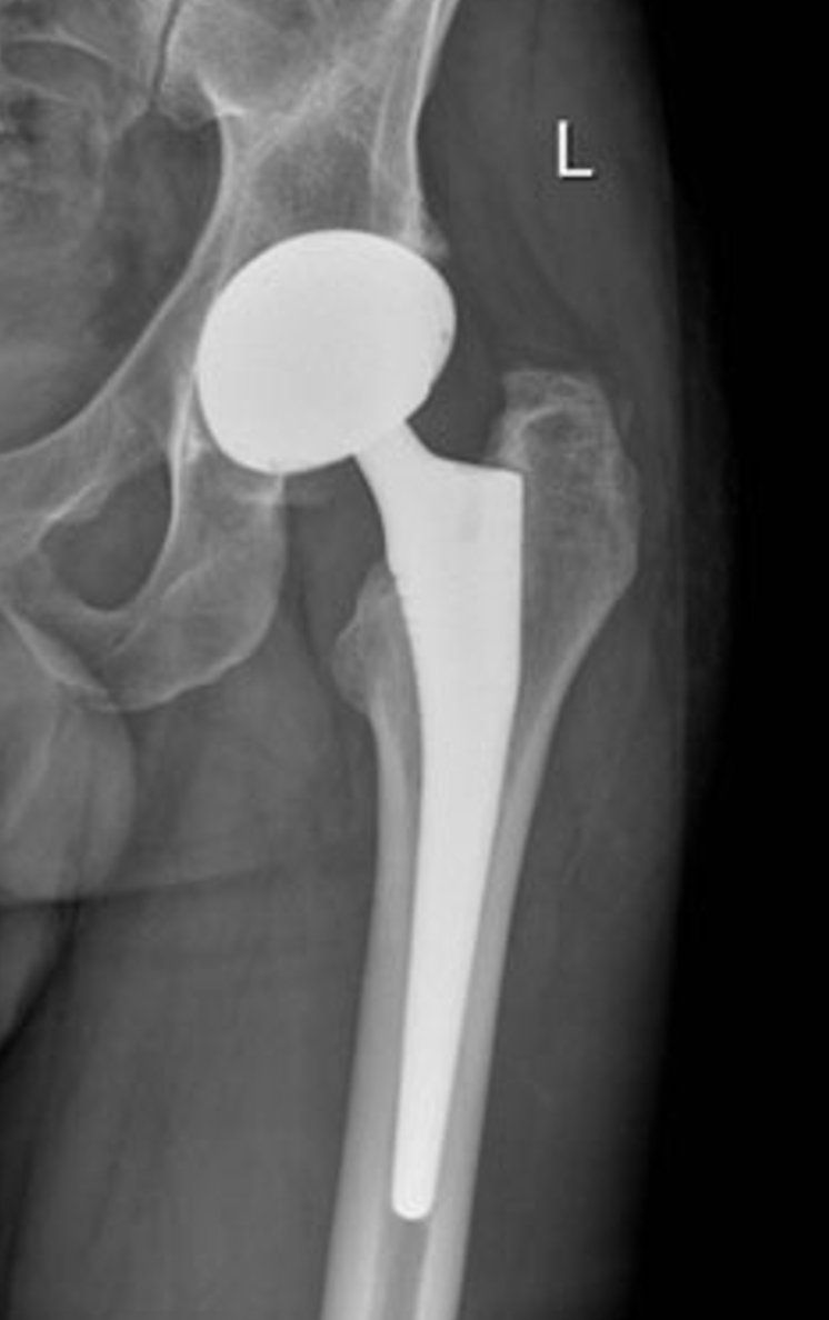 Dr Rollier / Chirurgie de la rotule Arthrosport - Argonay