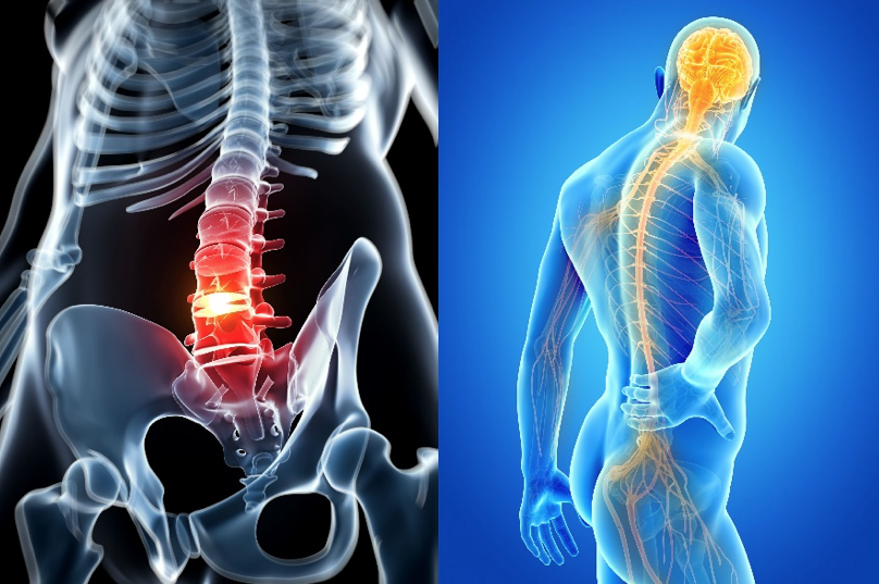 Informations sur les discopathies / Arthrosport - Argonay