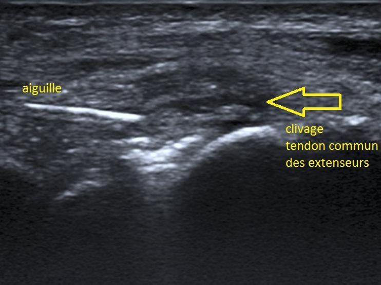 Dr Le Masle-Lastiolas / Ténotomie sous échographie Arthrosport Argonay