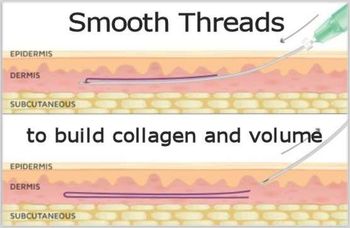 PDO Thread Lift - Results Matter