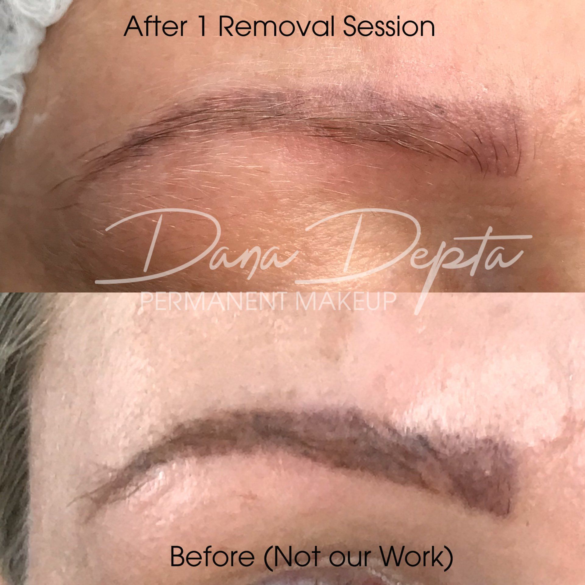 Saline Removal Photos | Dana Depta Permanent Makeup