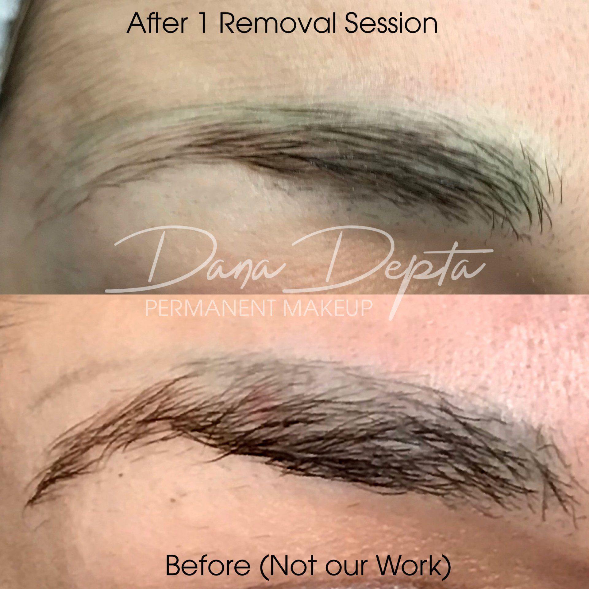 Permanent Makeup Removal | Dana Depta Permanent Makeup