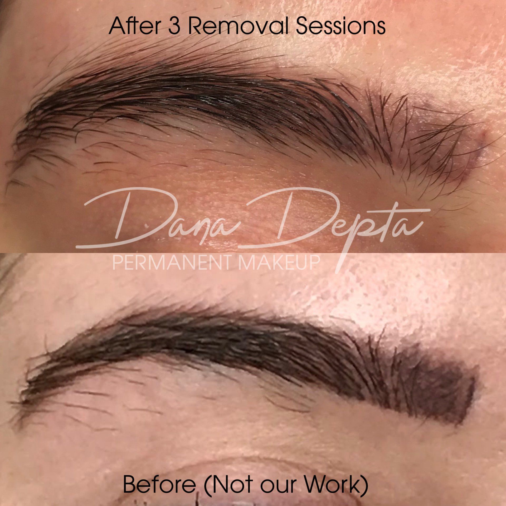 Saline Removal Photos | Dana Depta Permanent Makeup