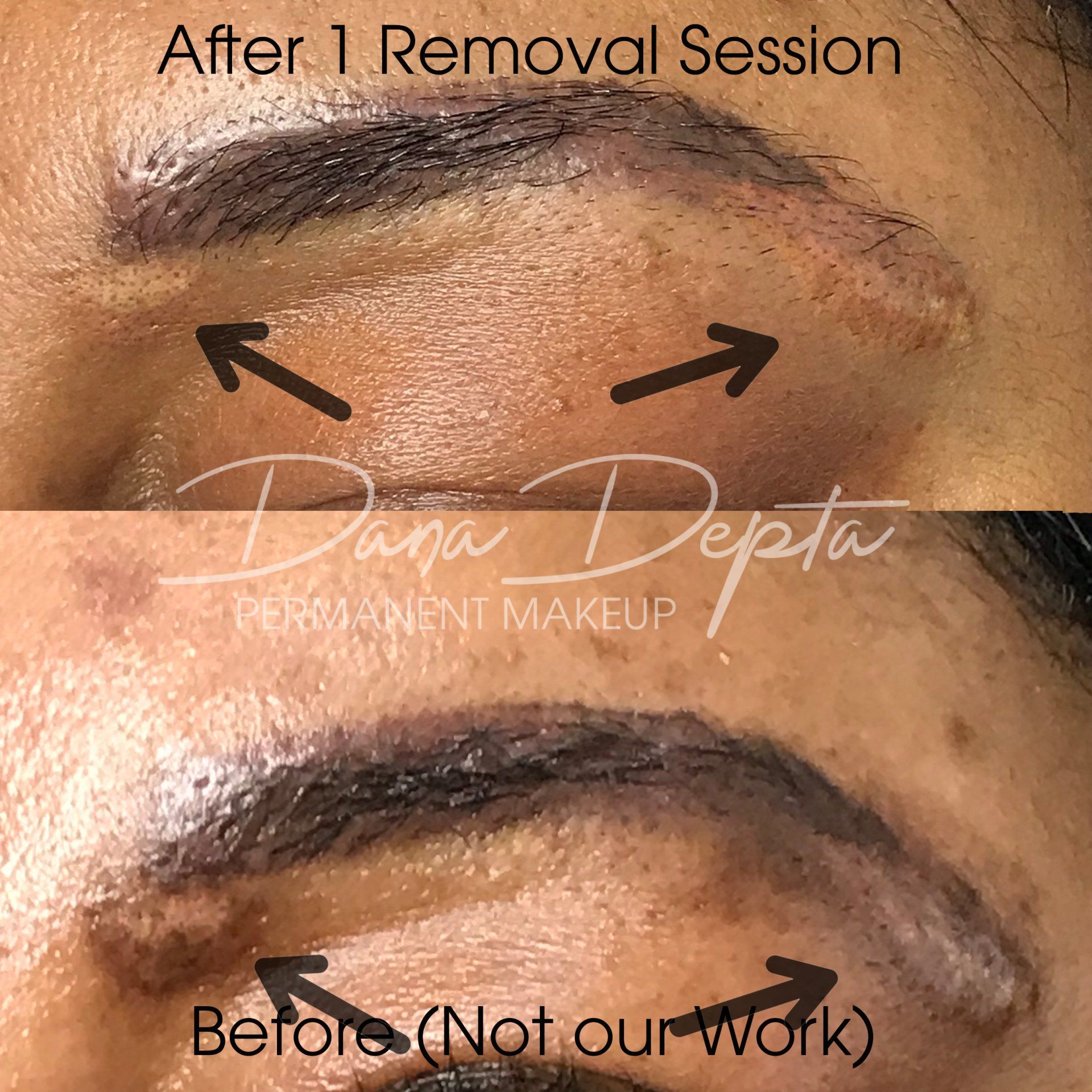 Saline Removal Photos | Dana Depta Permanent Makeup