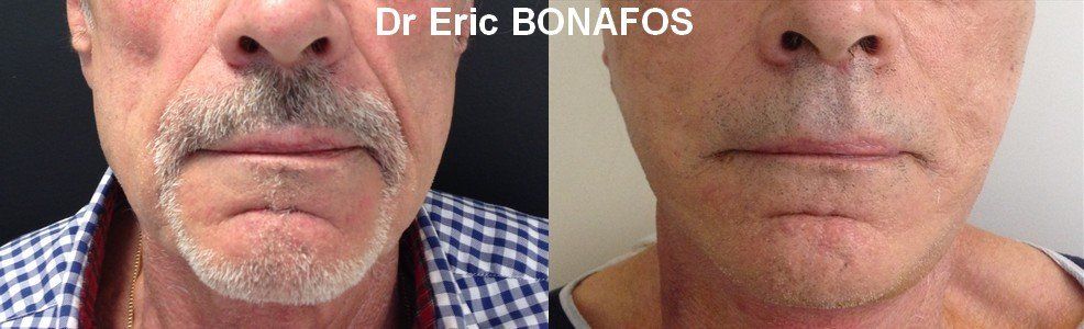 Dr Eric Bonafos | lipofilling à Montpellier | lipostructure à ...